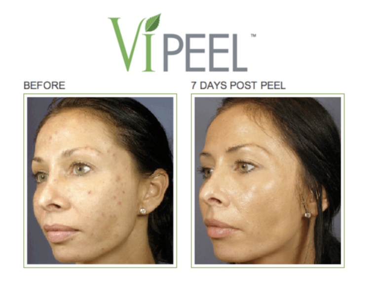 Chemical Peels - Vixen Aesthetics